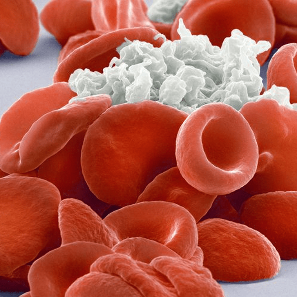 Lupus Anticoagulant 
